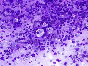 Salpingitis y ooforitis xantogranulomatosa: presentación de 2 casos ...