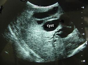 Choledochal cysts in children: How to Diagnose and Operate on | Clinics