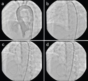 Transcatheter Closure of Perimembranous Ventricular Septal Defects in ...