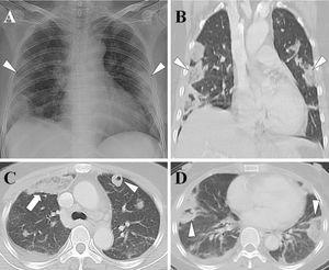 Septic Pulmonary Embolism Requiring Critical Care: Clinicoradiological ...