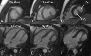 Double-chambered left ventricle in an adult: diagnosis by CMRI | Clinics