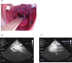 An atypical presentation of Kawasaki disease: a 10-year-old boy with ...