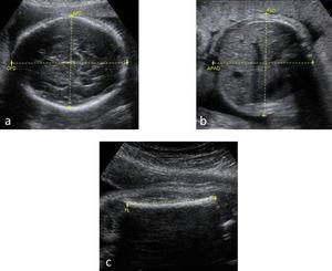 Longitudinal reference ranges for fetal ultrasound biometry in twin ...