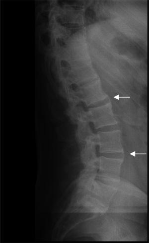 Hypoparathyroidism mimicking ankylosing spondylitis and myopathy: a ...