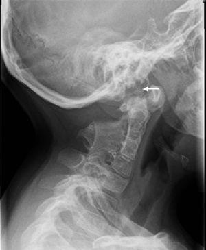 Occipito-Vertebral Dissociation in Connection with Extensive Cervical ...