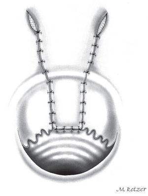 SURGICAL TREATMENT OF ANAL STENOSIS: ASSESSMENT OF 77 ANOPLASTIES | Clinics