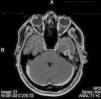 Rare case of neurinoma of the facial nerve | Brazilian Journal of ...