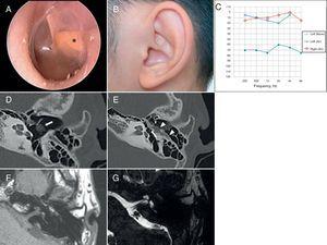 Deviant facial nerve course in the middle ear cavity | Brazilian ...