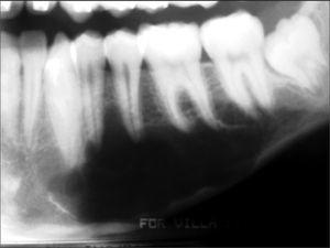 Traumatic bone cyst of the mandible: a review of 26 cases | Brazilian ...