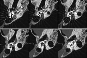 Cochlear implantation trough the middle cranial fossa: a novel approach ...