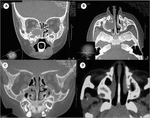 Maxillary mucocele in a 4-month infant | Brazilian Journal of ...
