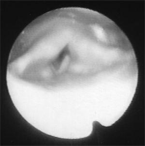 The difficult management of patients with respiratory segmental ...
