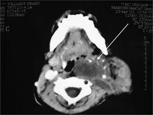 Neck Neurofibromatosis: clinical and surgical features | Brazilian ...