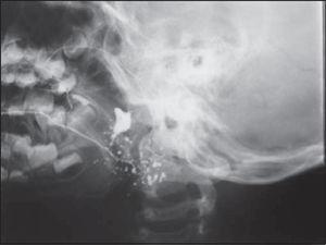 Infantile recurrent parotitis: follow up study of five cases and ...