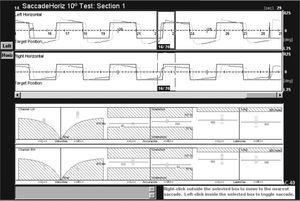 Saccadic Movements in subjects with cerebellar disorders | Brazilian ...