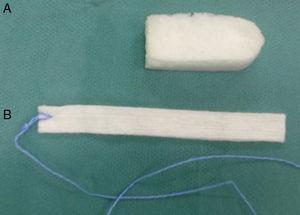 Clinical outcome and patient satisfaction using biodegradable (NasoPore ...