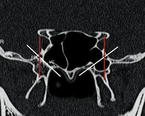 The sphenoid sinus, foramen rotundum and vidian canal: a radiological ...
