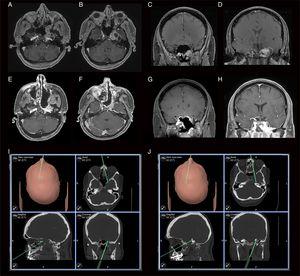 Endoscopic endonasal access for the treatment of Vidian nerve ...