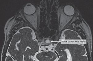 Prostatic carcinoma metastatic to frontal and cavernous sinuses: a case ...