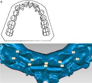Side effects of intraoral devices for OSAS treatment | Brazilian ...