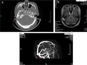 The styloid process and the formation of sigmoid sinus diverticulum: is ...