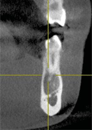 Solitary mandibular bone cyst. Case report and literature review ...