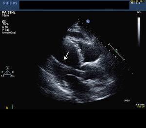 Long-term Pacemaker Lead Malposition. Role of Echocardiography ...