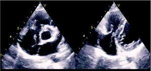 Chiari's Network and Paroxysmal Atrial Fibrillation | Revista Española ...