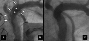 Conservative Management of Iatrogenic Subclavian Artery Dissection ...