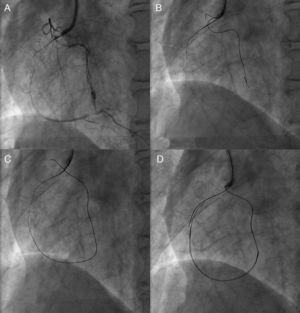 Current Percutaneous Recanalization of Coronary Chronic Total Occlusion ...