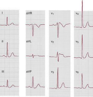 Brugada Electrocardiogram Pattern Induced by Cannabis | Revista ...