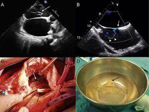Giant Chiari Network, Foramen Ovale, and Paradoxical Embolism | Revista ...