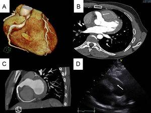 Características ecocardiográficas de la mesocardia fetal: un corazón ...