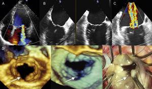 Guidewire-driven Left Ventricular Pacing During Transcatheter Aortic ...