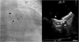Left atrial appendage closure with 2 different devices | Revista ...