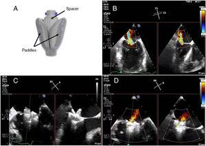 Transcatheter mitral valve repair with the PASCAL system: initial ...