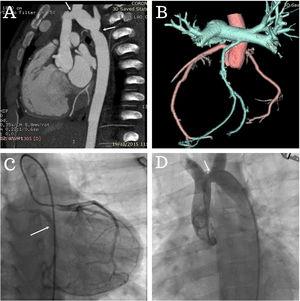 Anomalous origin of circumflex artery with atypical aortic coarctation ...
