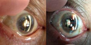 Anterior vaulting of single piece in-the-bag intraocular lens after ...