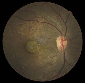 Central areolar choroidal dystrophy with associated dominant drusen ...
