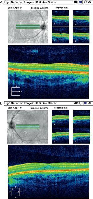 Macular pigment optical density spatial distribution measured in a ...
