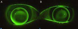 Short-term corneal changes with gas-permeable contact lens wear in ...