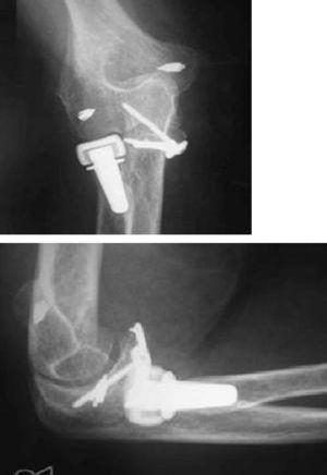 Tratamiento quirúrgico protocolizado de la «tríada terrible» de codo ...