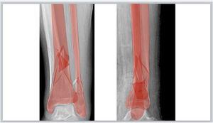[Translated article] Fracture planning is easy: Development of a basic ...