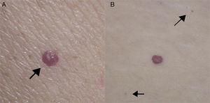 Puntos de Campbell de Morgan, hemangioma capilar o angioma senil ...