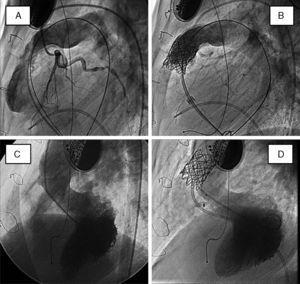 Intervencionismo percutáneo en cardiopatías congénitas. Obstrucciones ...