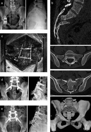 Sacral fracture with spino-pelvic dissociation: A literature review ...