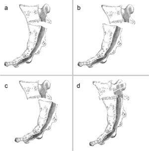 Sacral fracture with spino-pelvic dissociation: A literature review ...