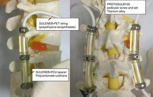Pedicular dynamic stabilization system. Functional outcomes and implant ...