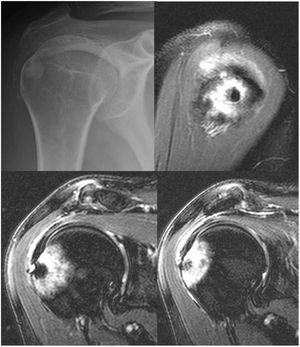 Calcific tendinopathy of the shoulder with intraosseous extension ...