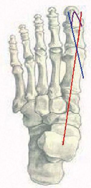 Técnica del radiofotopodograma | Imagen Diagnóstica
